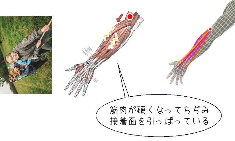 肘の痛み！【ひじの外側が痛い時】の自宅治療法とストレッチテニス肘 『レントゲン異常なし』と言われた後の体の痛みの治しかた