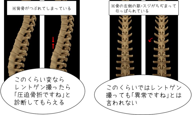 背中の痛み!【背骨が痛い時】の自宅治療法とストレッチ 『レントゲン異常なし』と言われた後の体の痛みの治しかた