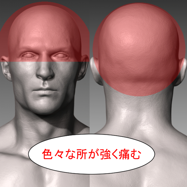 頭の痛み【一覧図】 『レントゲン異常なし』と言われた後の体の痛みの治しかた