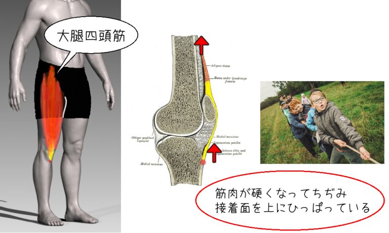 膝を曲げると痛い！【お皿の下】の痛みの治療法10代の子供に多いです 『レントゲン異常なし』と言われた後の体の痛みの治しかた